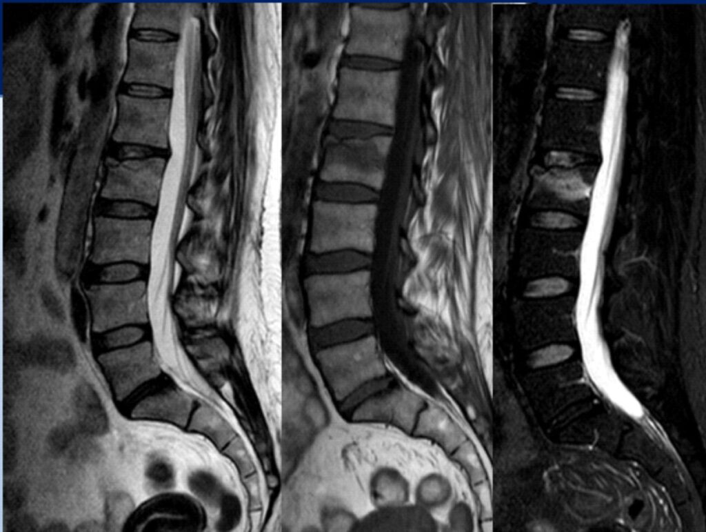 Curso de Diagnóstico Imagenológico de la Columna Vertebral – SOPEDIA